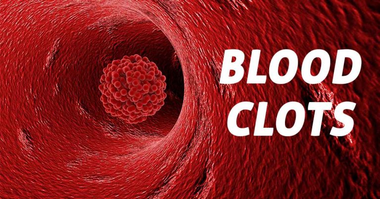 Signs and Symptoms of Blood Clots - Beaumont Emergency Hospital