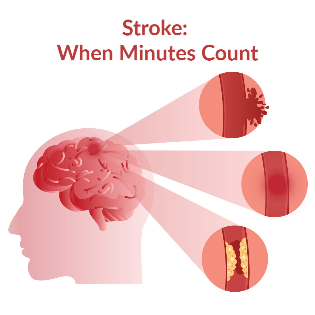 First Aid For Stroke - Beaumont Emergency Hospital