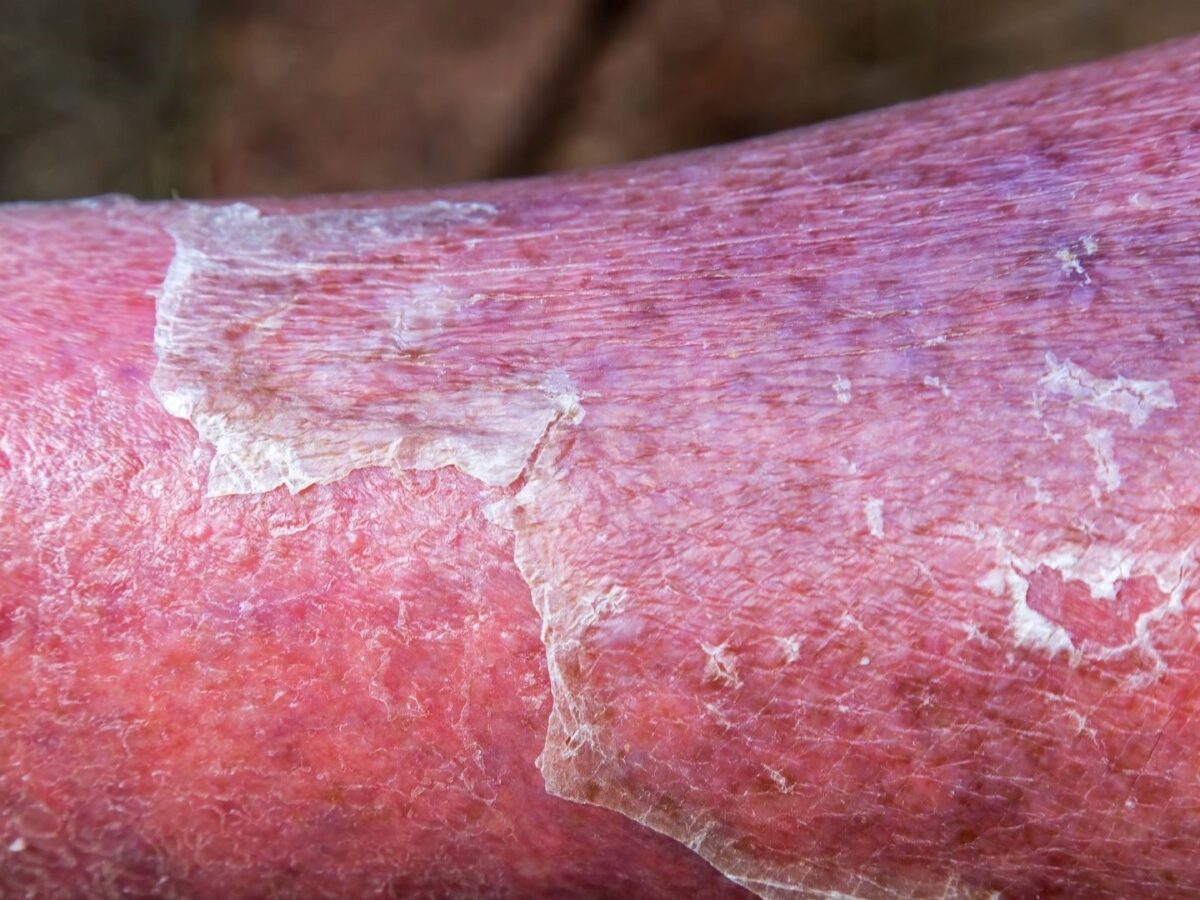 Cellulitis Archives - Beaumont Emergency Hospital